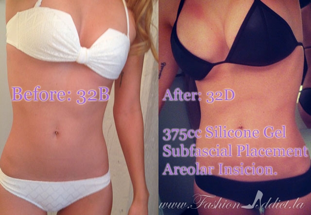 Boob Job Recovery 4 Weeks Post Op Kier Couture